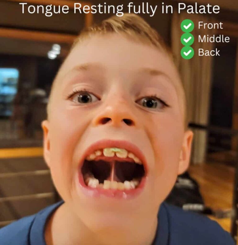 Kids and their new MyoMunchee - Apex Dental