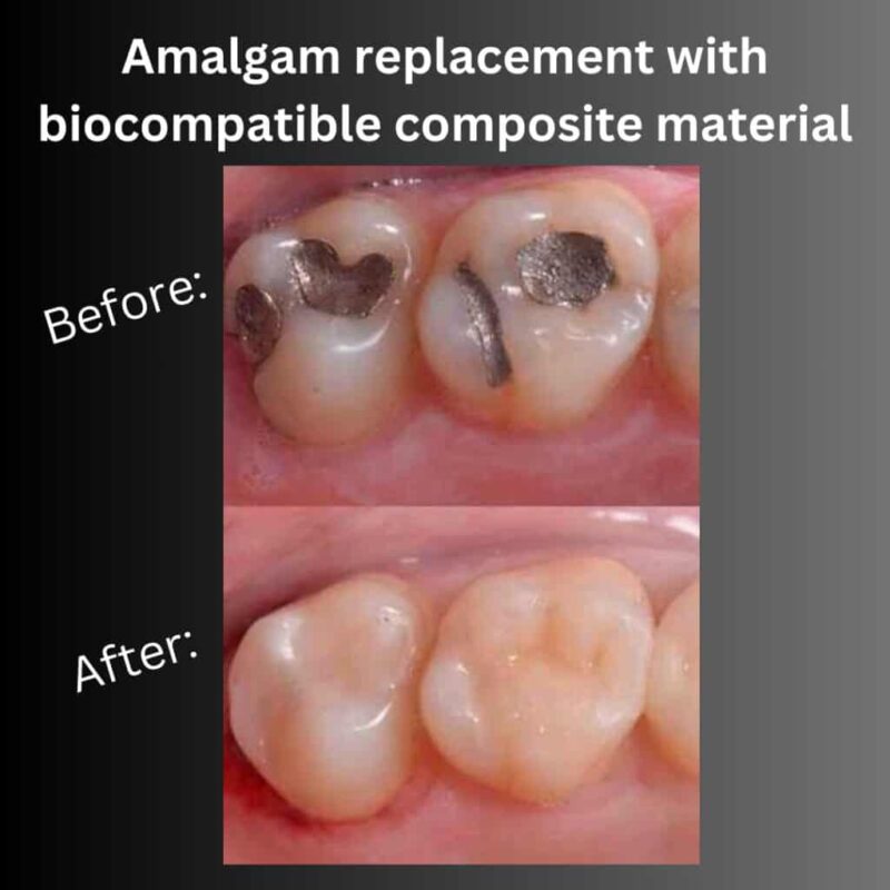 The Art of Safe Amalgam Removal & Mercury Detox - Apex Dental